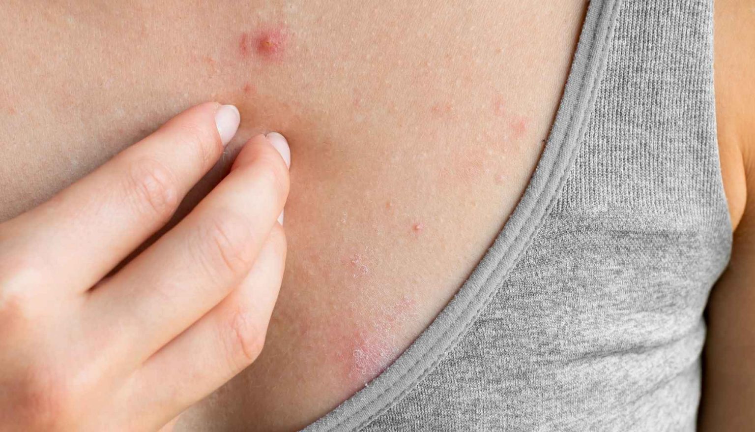 💁‍♀️ Me salen granos en el pecho⏩ causas y soluciones